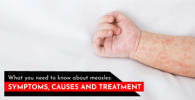 All About Measles Disease: Causes, Spread, Symptoms And Treatment | MrMed